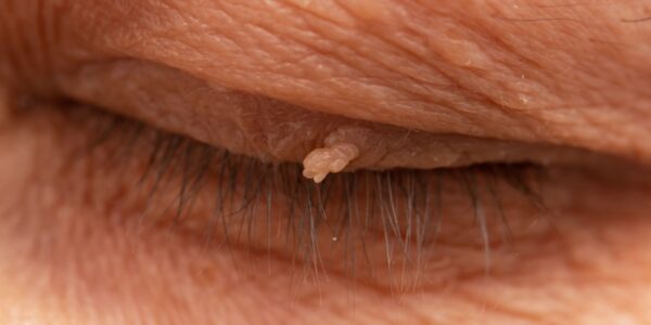 Θηλώματα: Τι Είναι & Γιατί Εμφανίζονται στο Δέρμα | Pharm24.gr