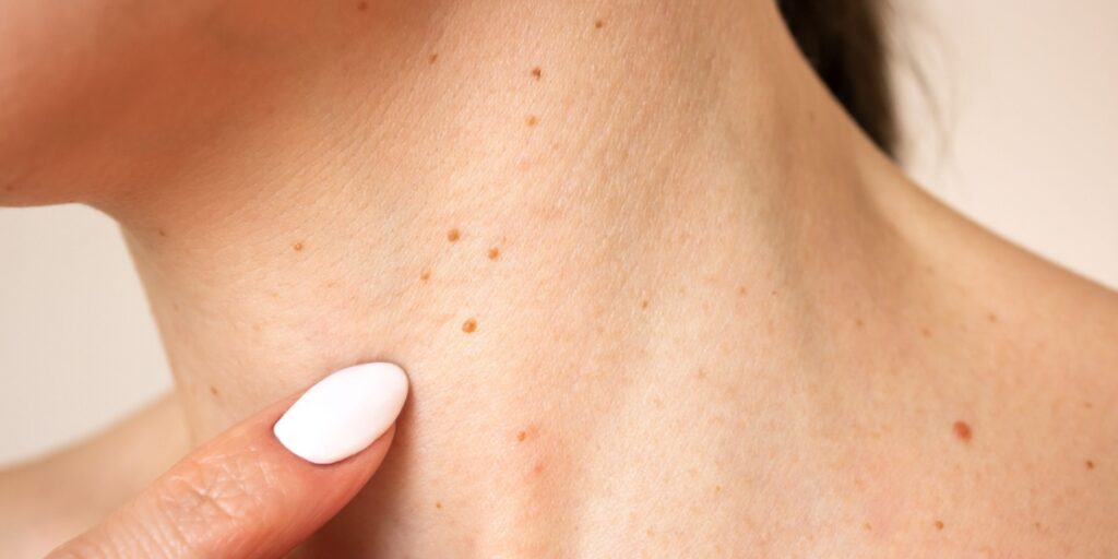 Θηλώματα: Τι Είναι & Γιατί Εμφανίζονται στο Δέρμα | Pharm24.gr